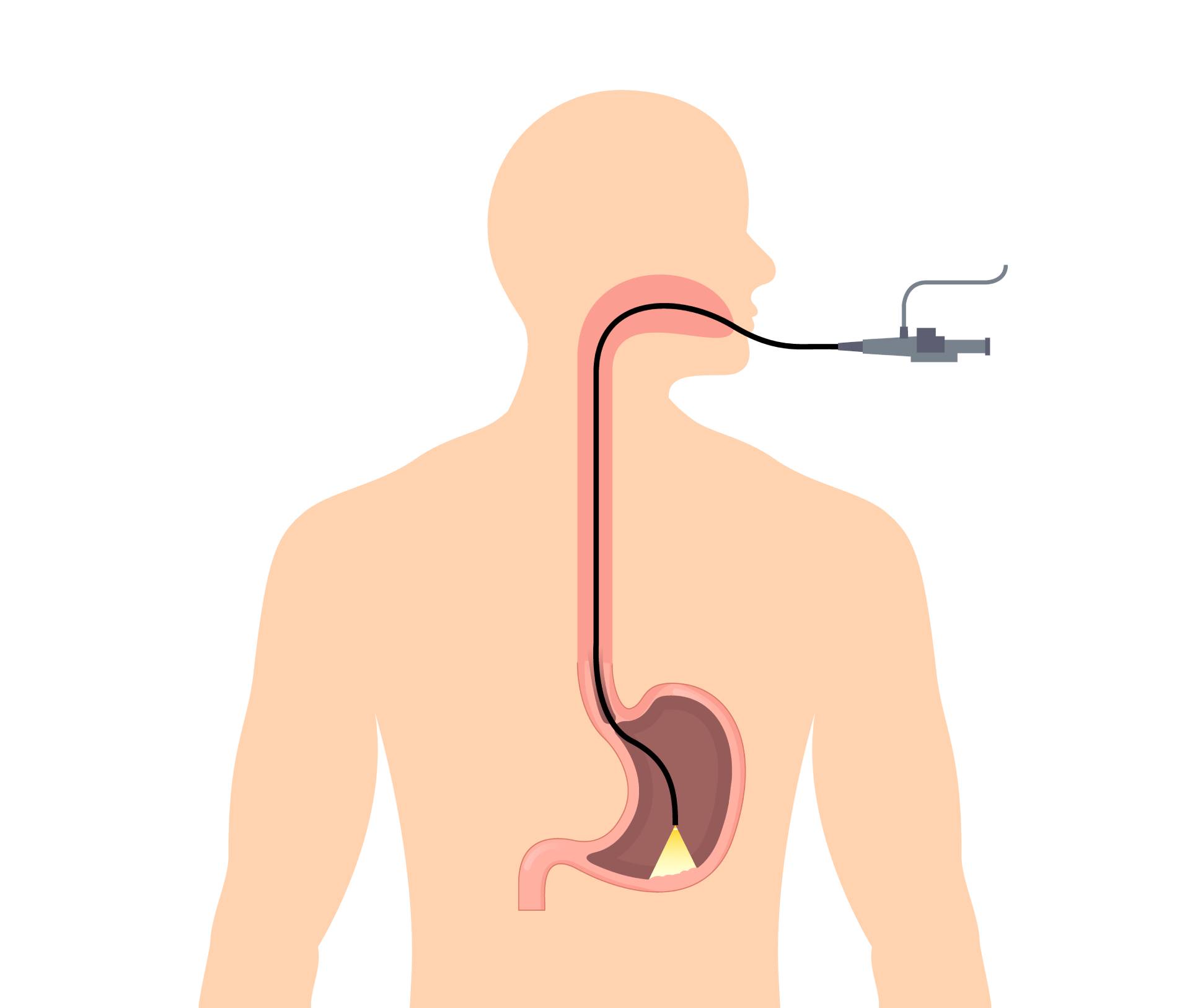 EGD (Esophagogastroduodenoscopy) Upper Endoscopy Utah | Granite Peaks ...